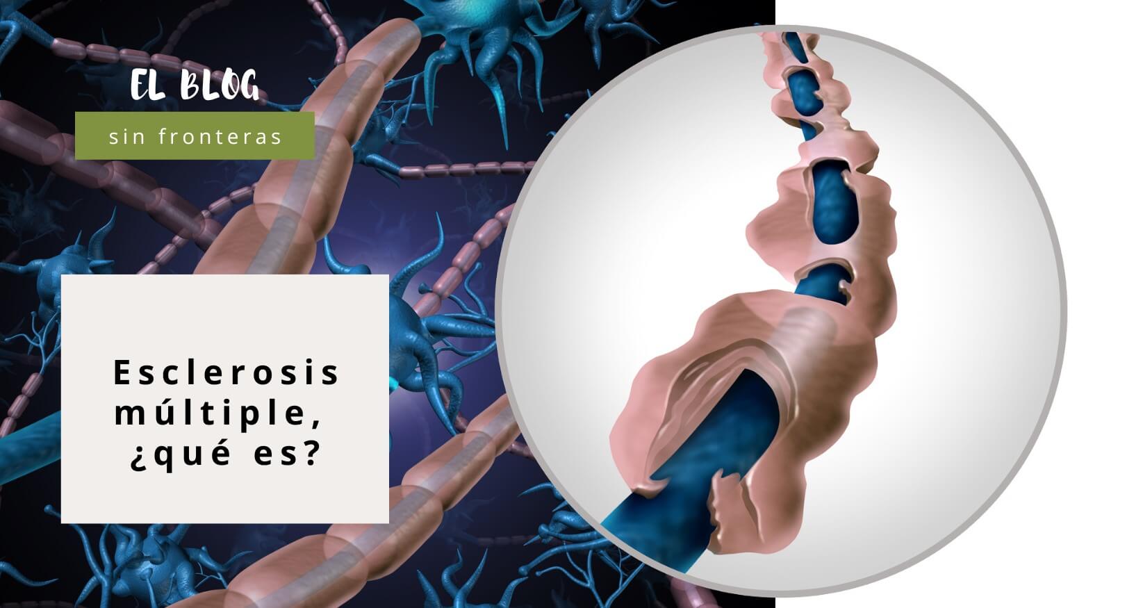 ¿Qué es esclerosis múltple?